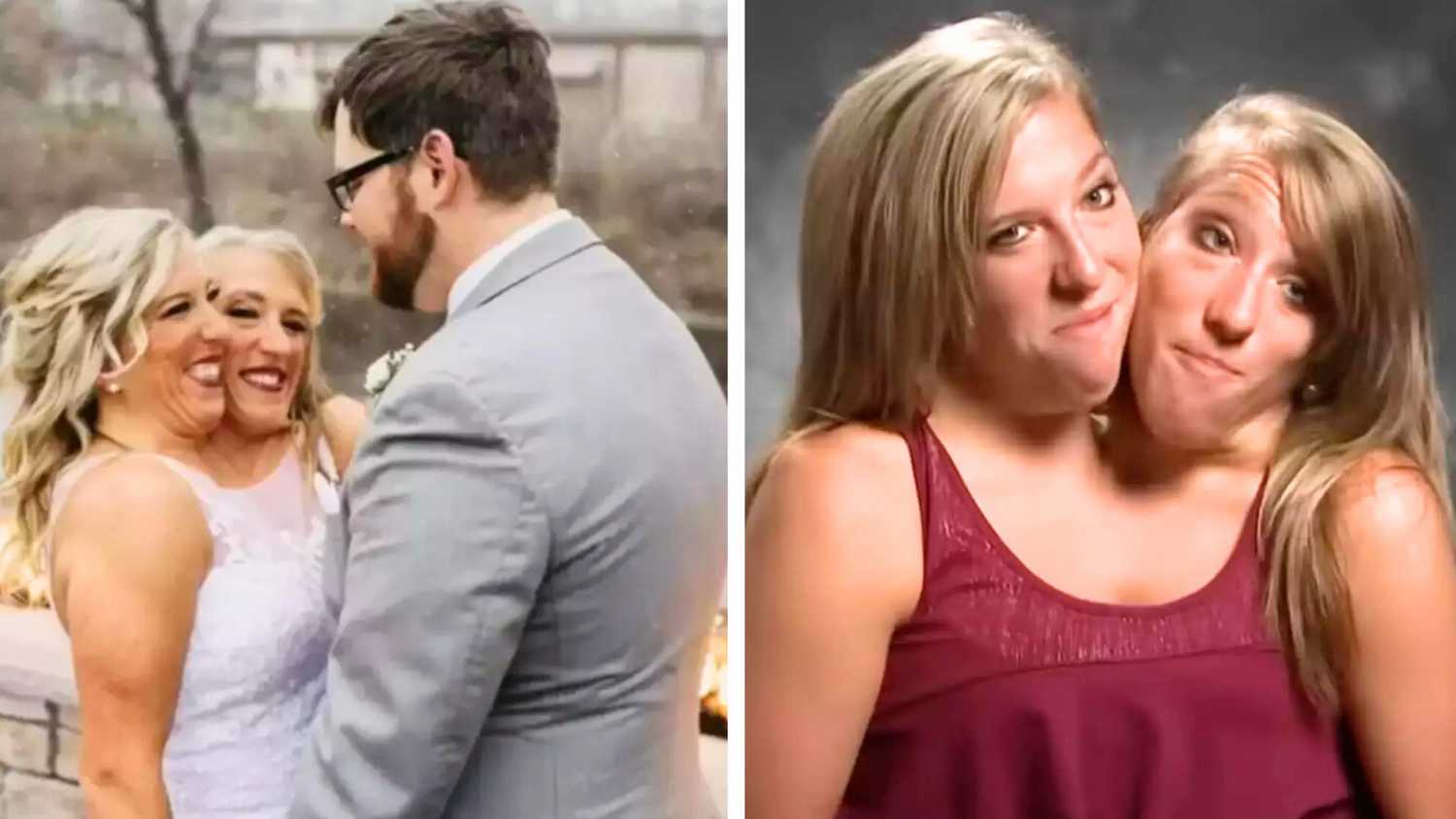 The love story behind the conjoined twins – Daniel D.